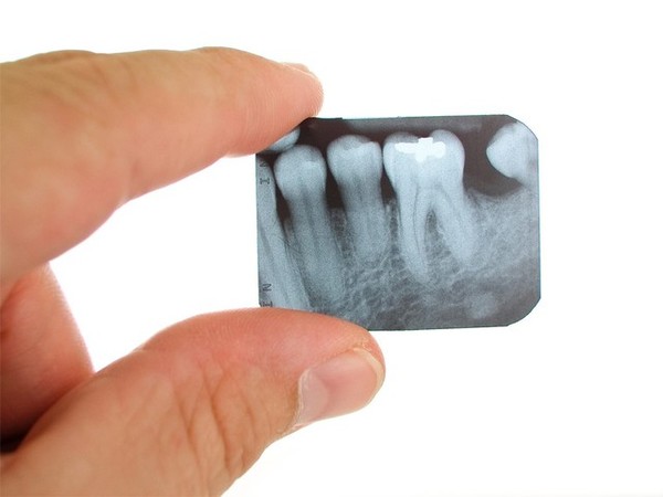 Wel of niet een röntgenfoto laten maken | Brabbels